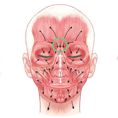 Zornesfalte entfernen mit Botox - Frischer Look & gutes Gefühl