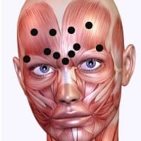 Botox Stirn | Stirnfalten glätten mit Botulinumtoxin