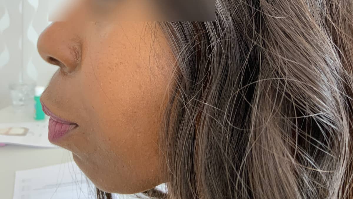 Fliehendes Kinn mit Hyaluron korrigieren | Kinnkorrektur ohne OP